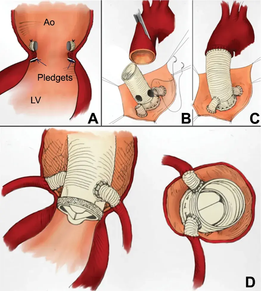 Bentall Surgery – Revocure
