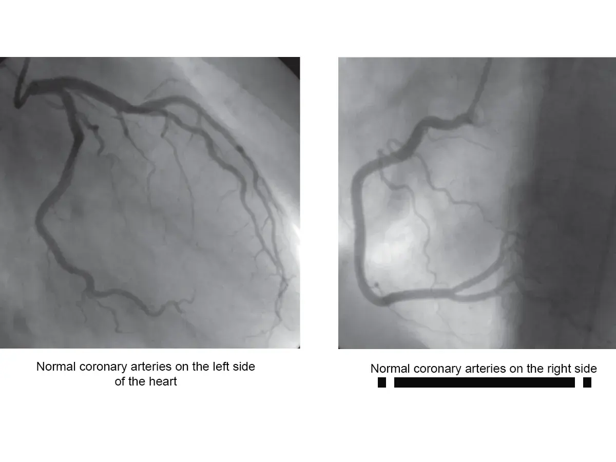 Coronary artery angiography (CAG) – Revocure